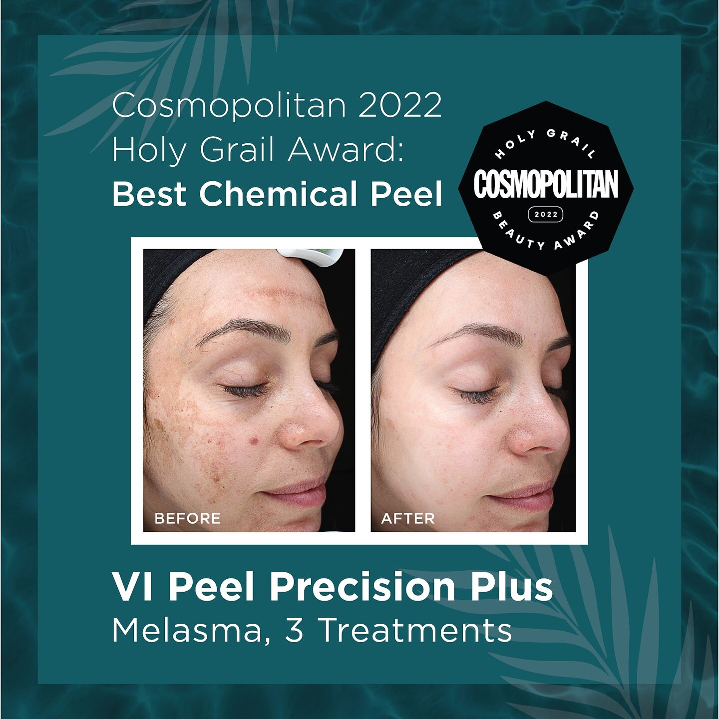 Best VI Peel Buena Park, Cupertino, CA | 17MedSpa